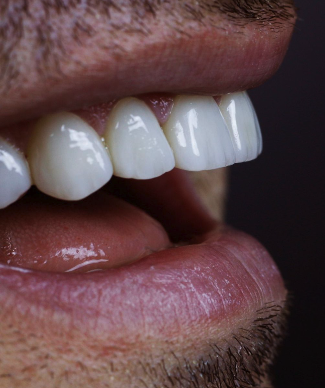 Periodontal Cleaning: The Key to Excellent Oral Health - Iconic Dental ...